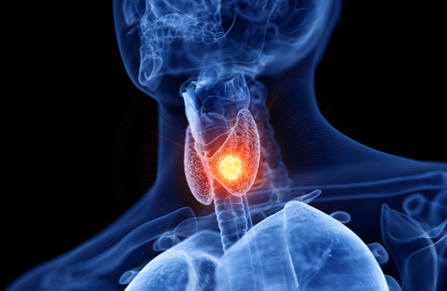 Launches First-In-Human Study on Non-Invasive Thyroid Cancer Diagnostic ...